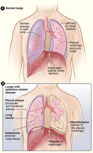 What is Mesothelioma? A Guide to Understanding this Rare Cancer